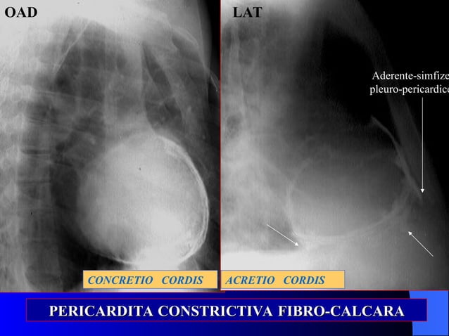 03 - cv - curs 6 - cm-pericardite.ppt.ppt