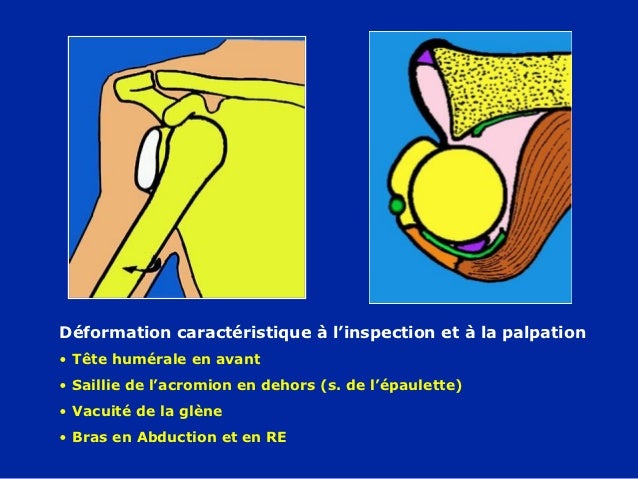 Hypoplasie De La Glène: Fracture De Glène Symptômes – LSBGB