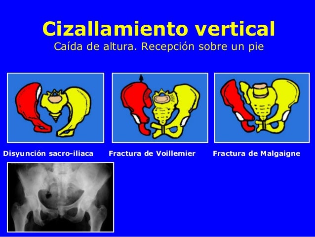 03 Fracturas De La Pelvis