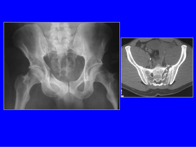 03 Fracturas De La Pelvis