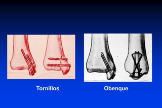03 fracturas del tobillo | PPT