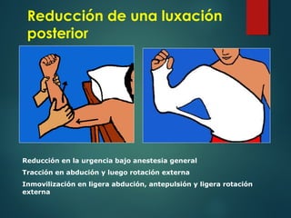 03 Hombro Luxaciones Upap Ppt