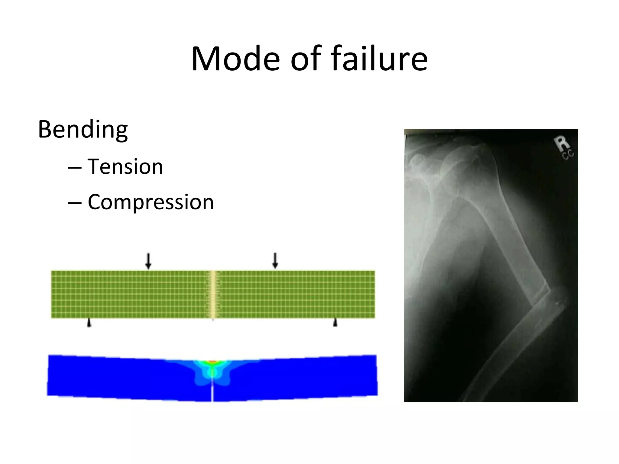 ortho 03 principle of closed reduction in fracture and dislocation | PPT