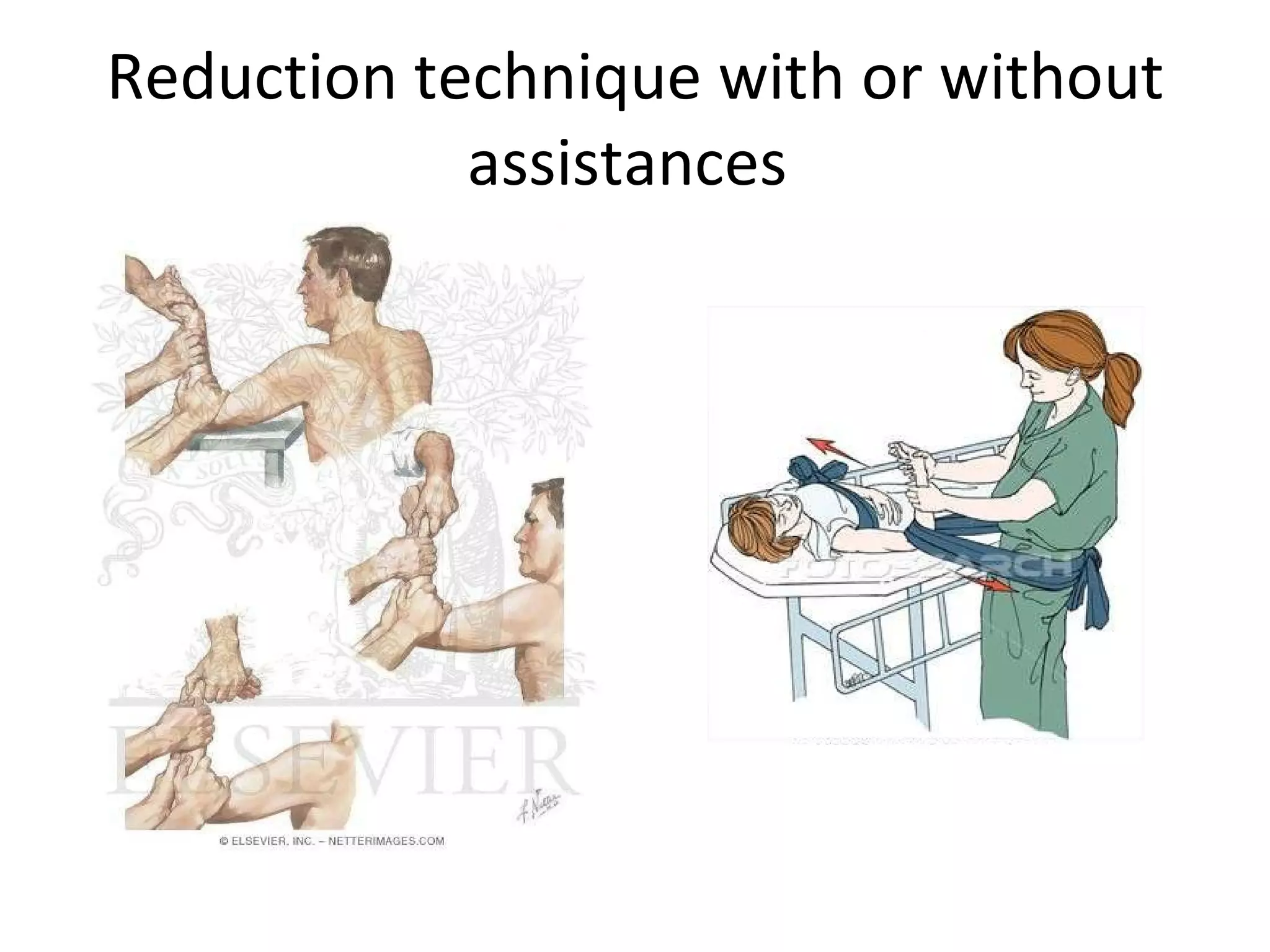 ortho 03 principle of closed reduction in fracture and dislocation | PPT