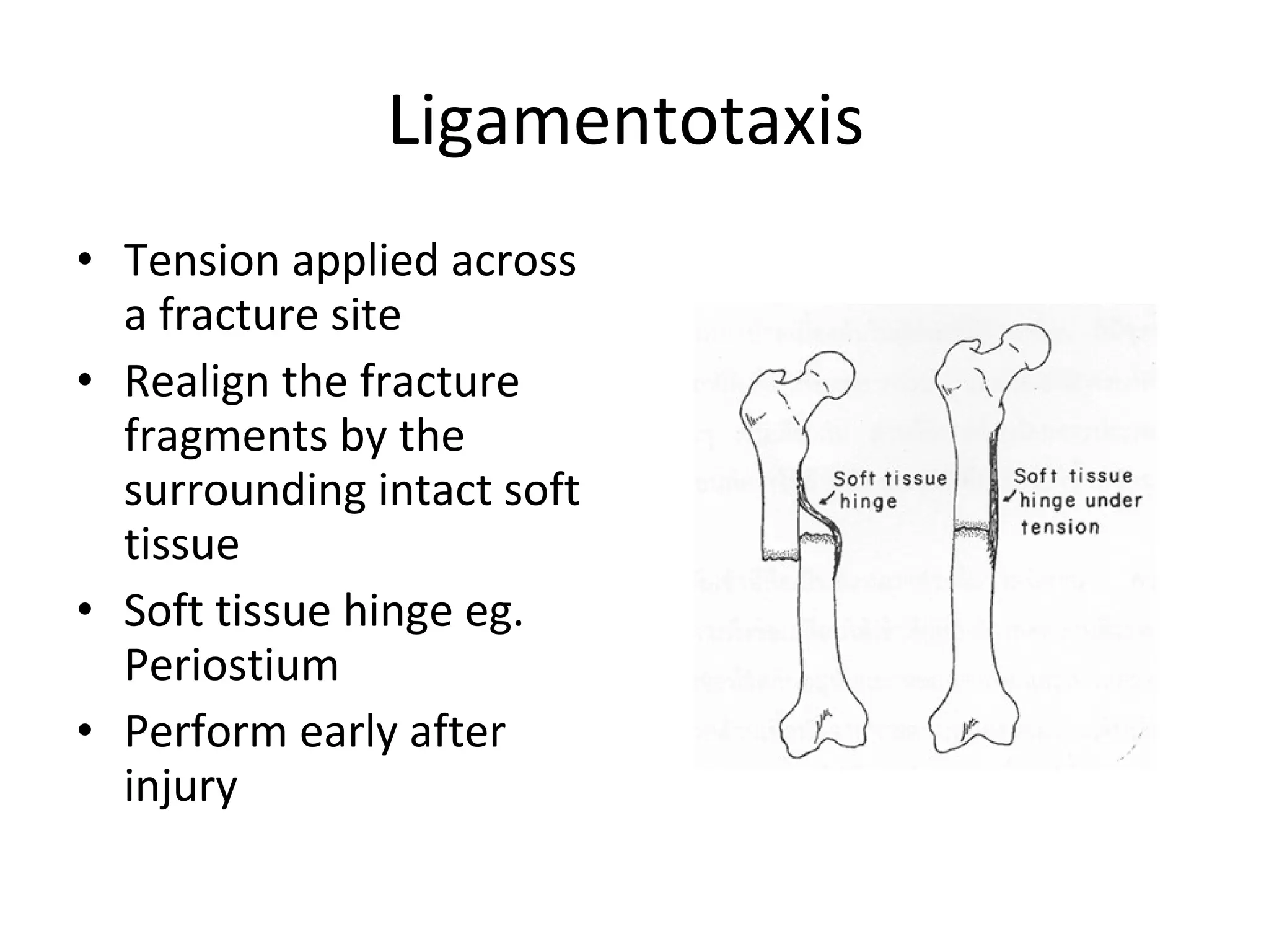 ortho 03 principle of closed reduction in fracture and dislocation | PPT