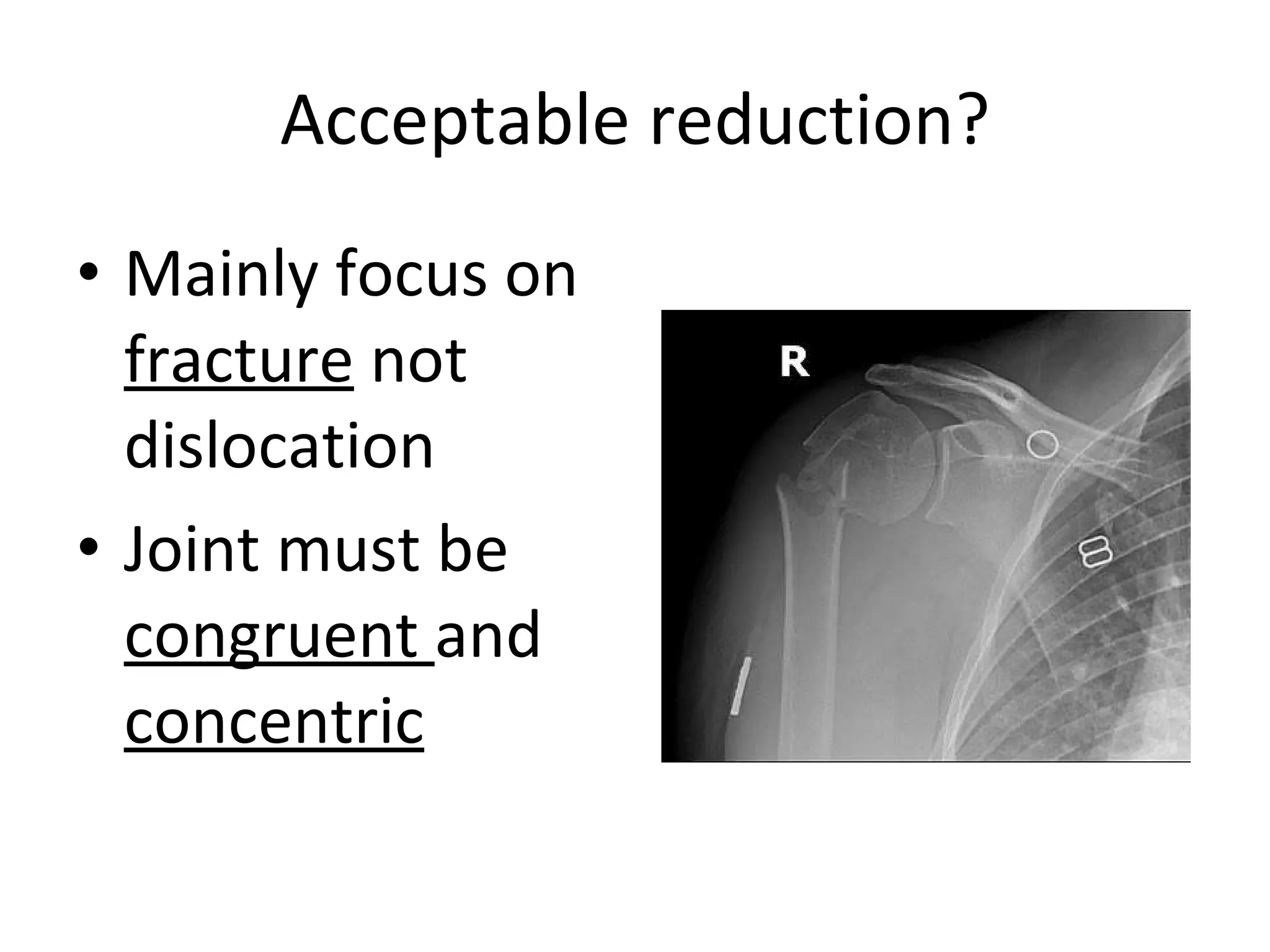 ortho 03 principle of closed reduction in fracture and dislocation | PPT