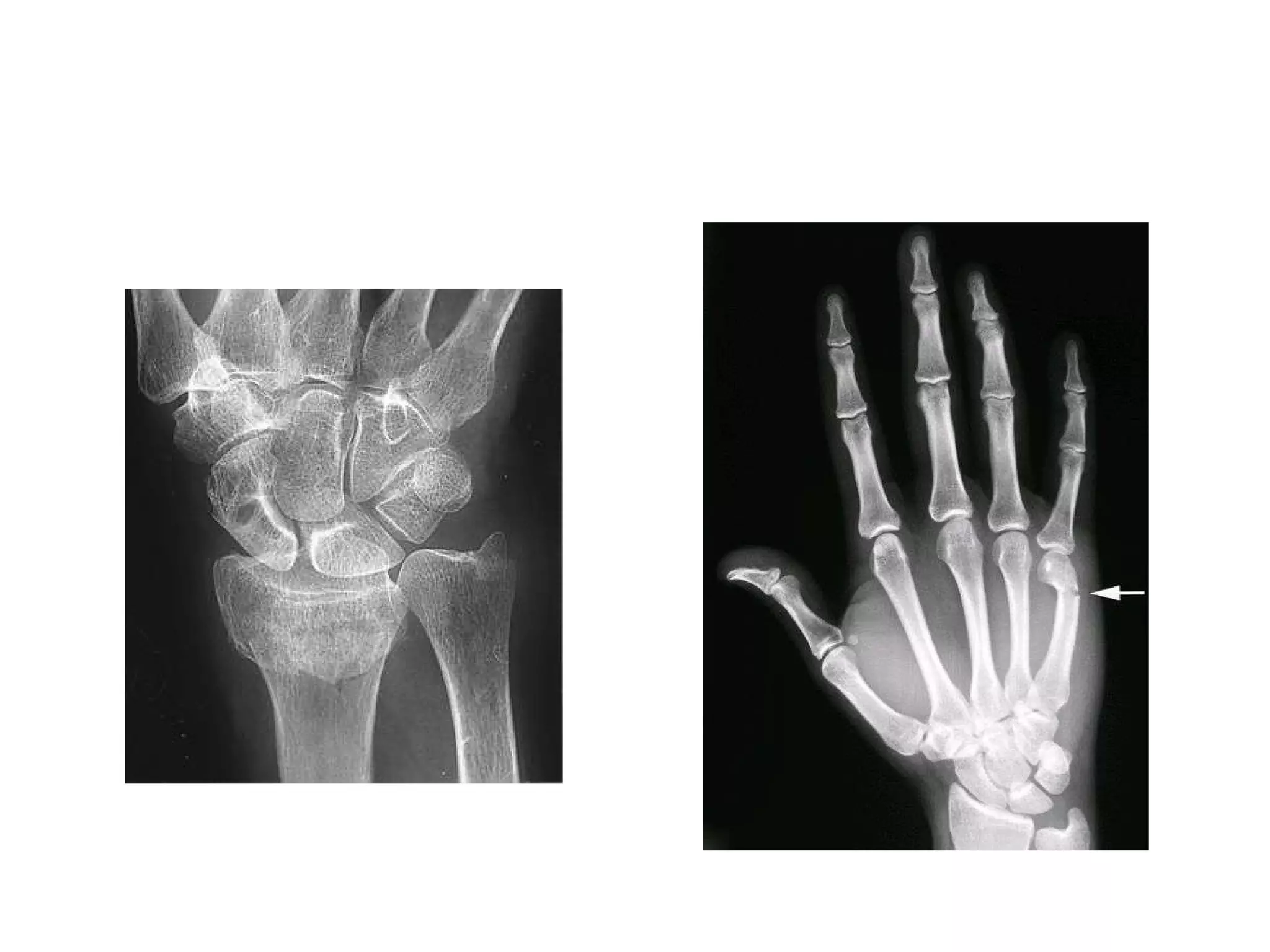 ortho 03 principle of closed reduction in fracture and dislocation | PPT