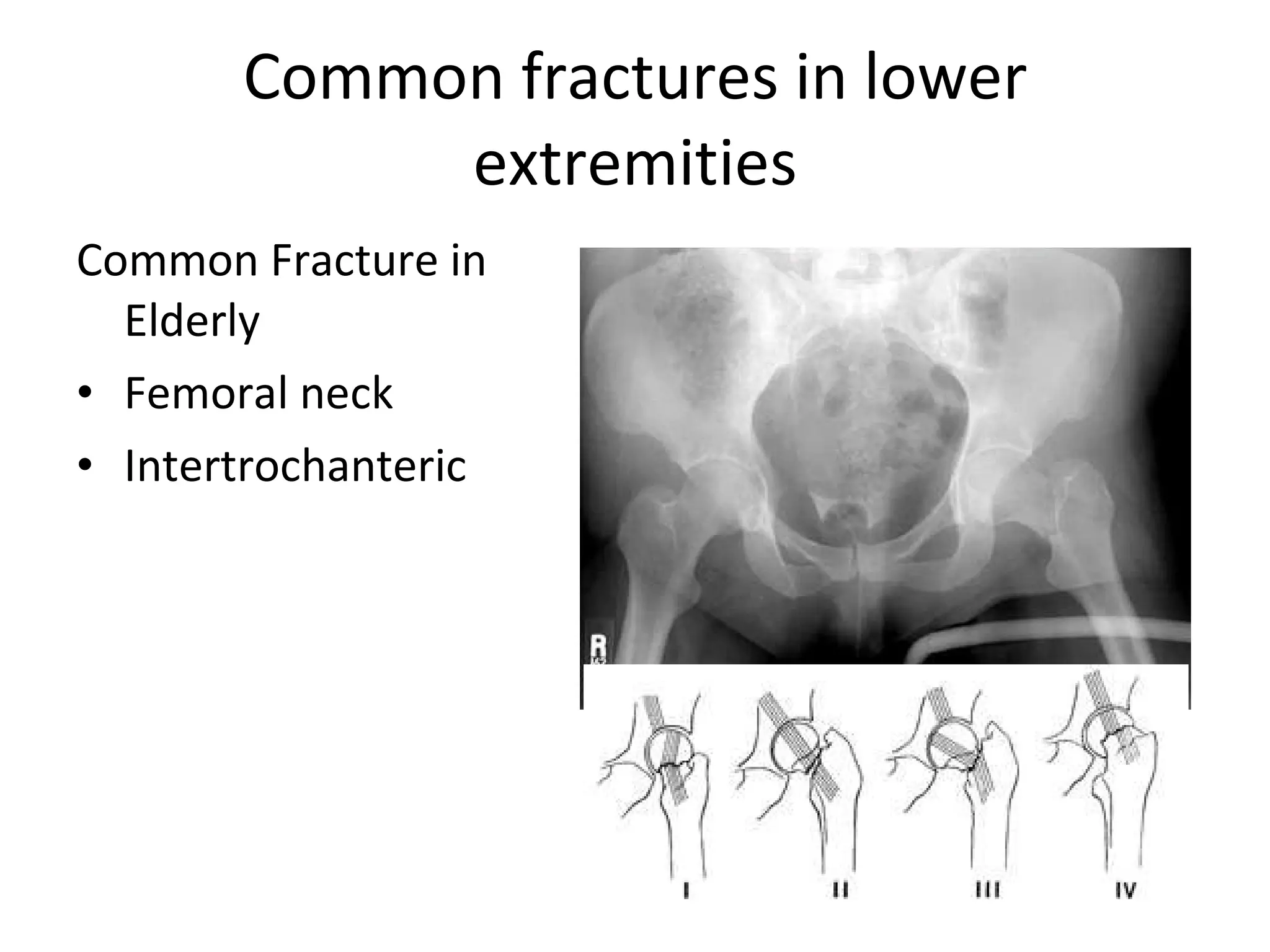 ortho 03 principle of closed reduction in fracture and dislocation | PPT