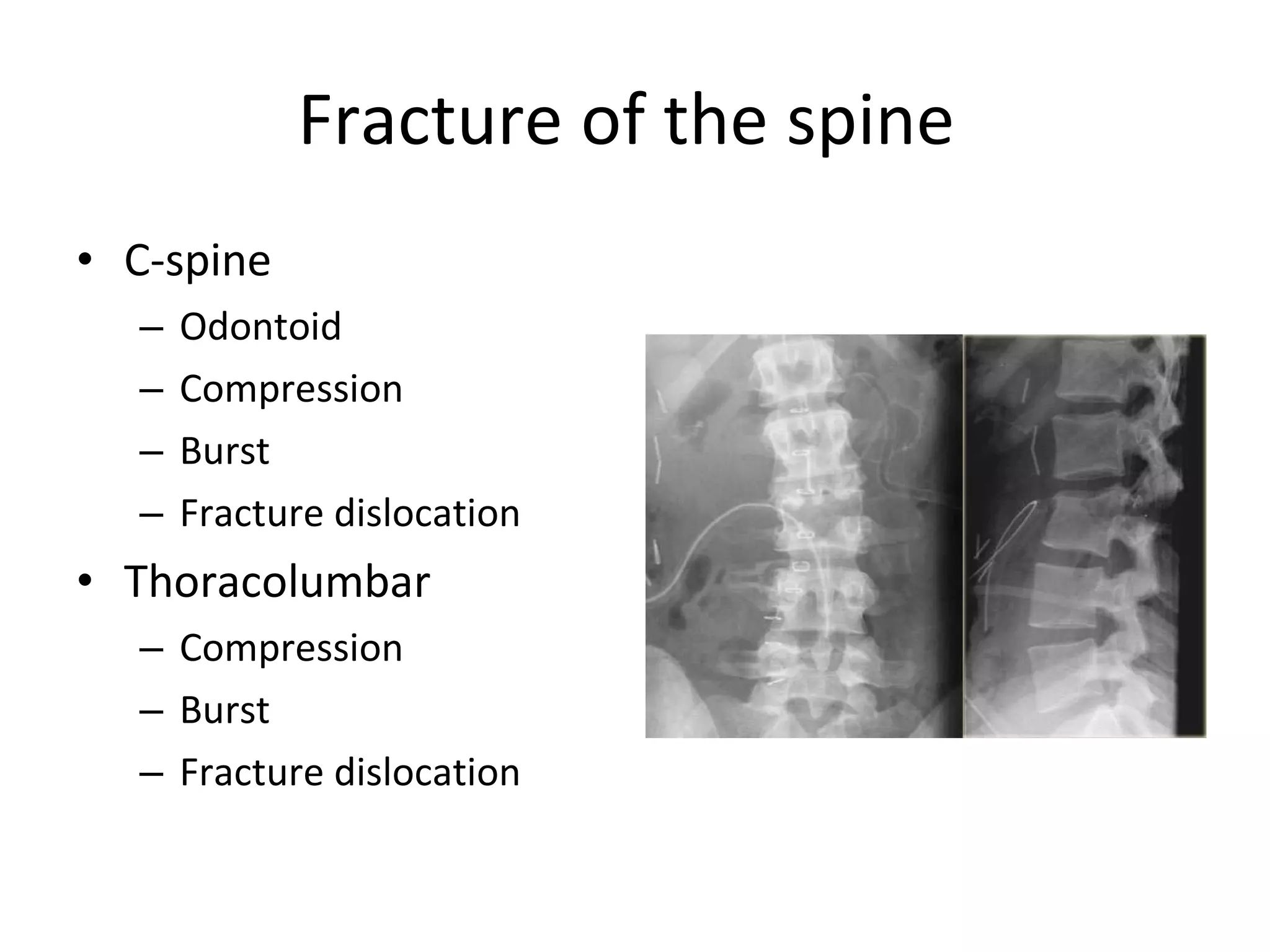ortho 03 principle of closed reduction in fracture and dislocation | PPT