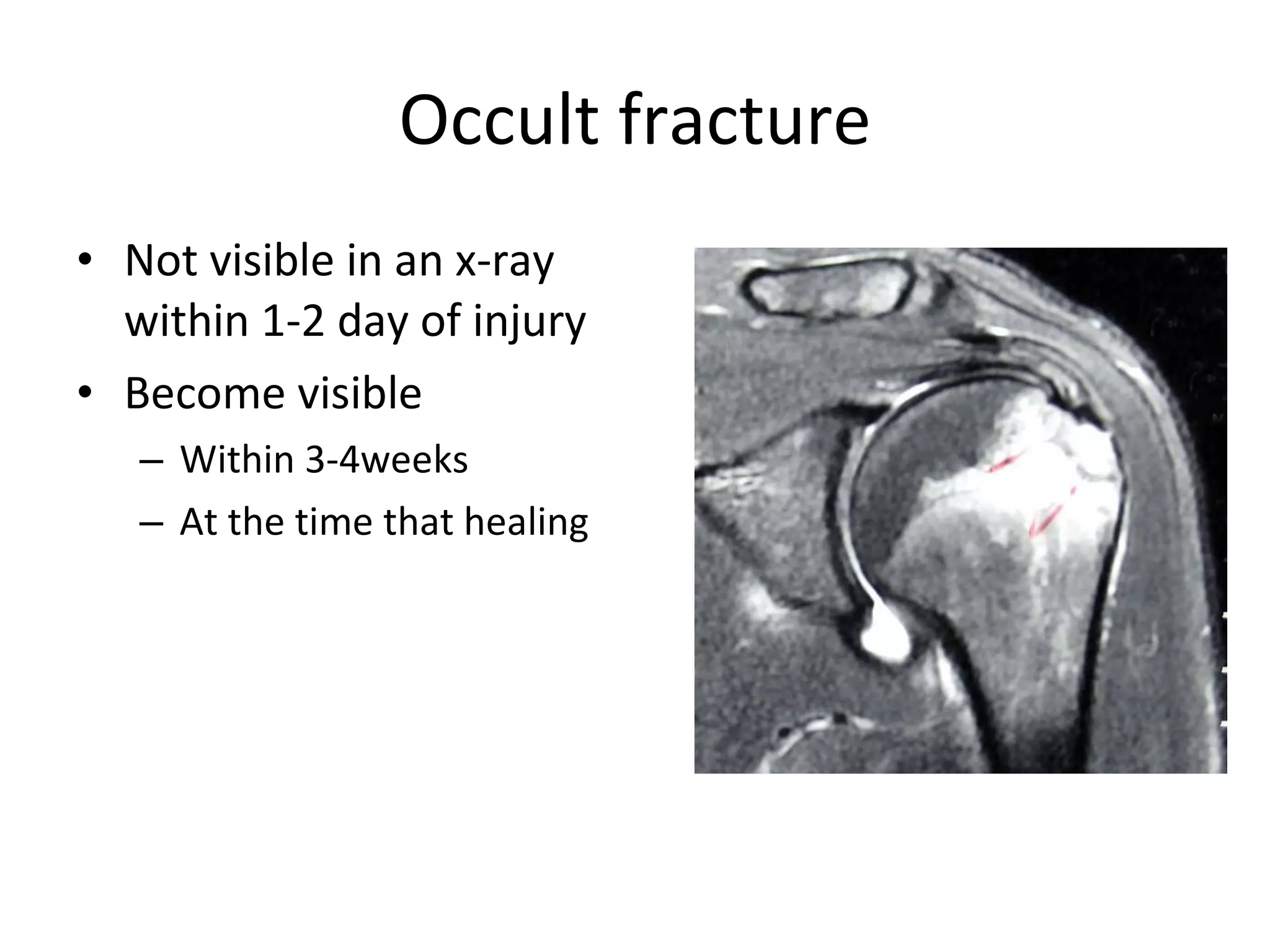 ortho 03 principle of closed reduction in fracture and dislocation | PPT