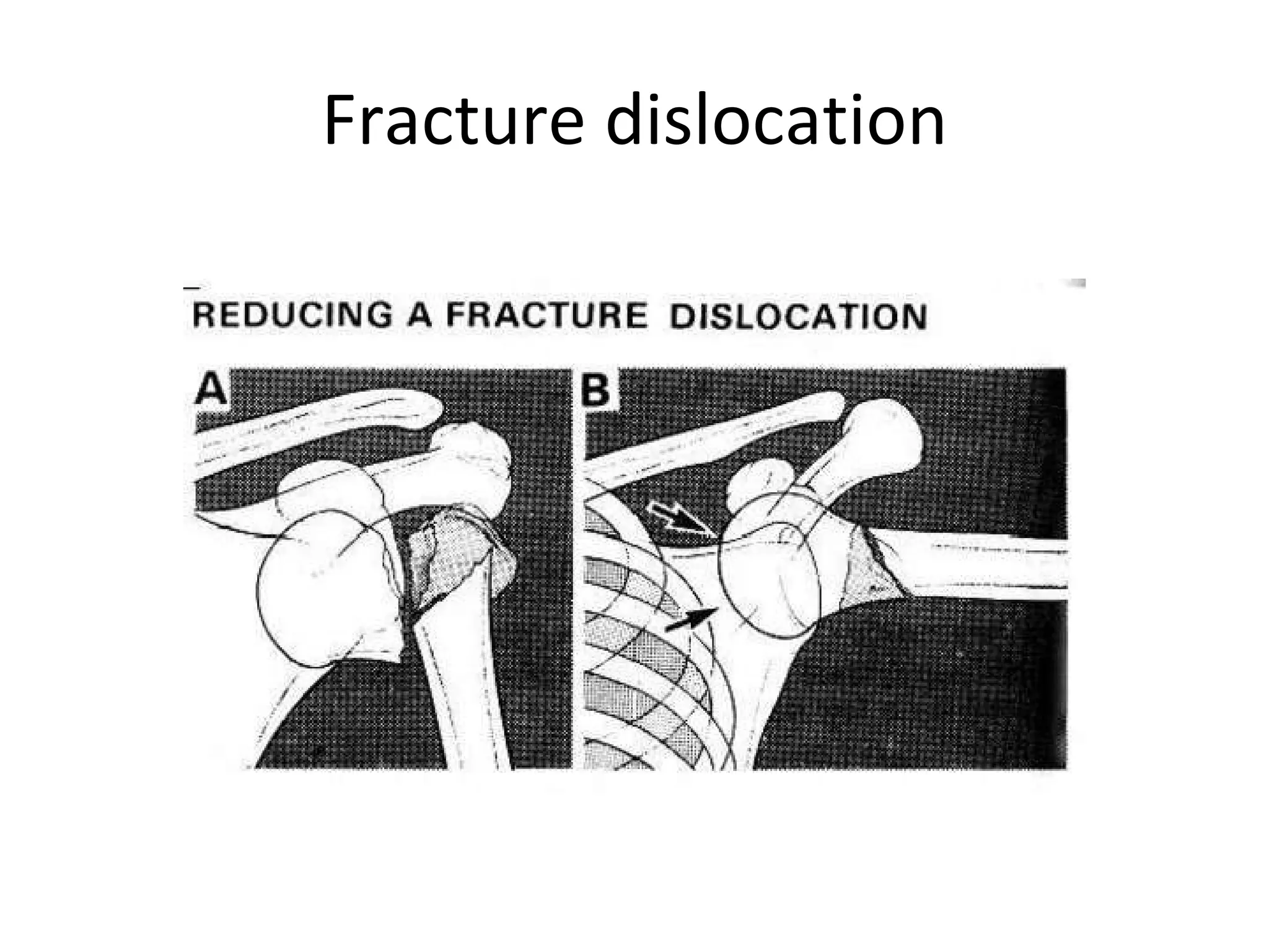 ortho 03 principle of closed reduction in fracture and dislocation | PPT