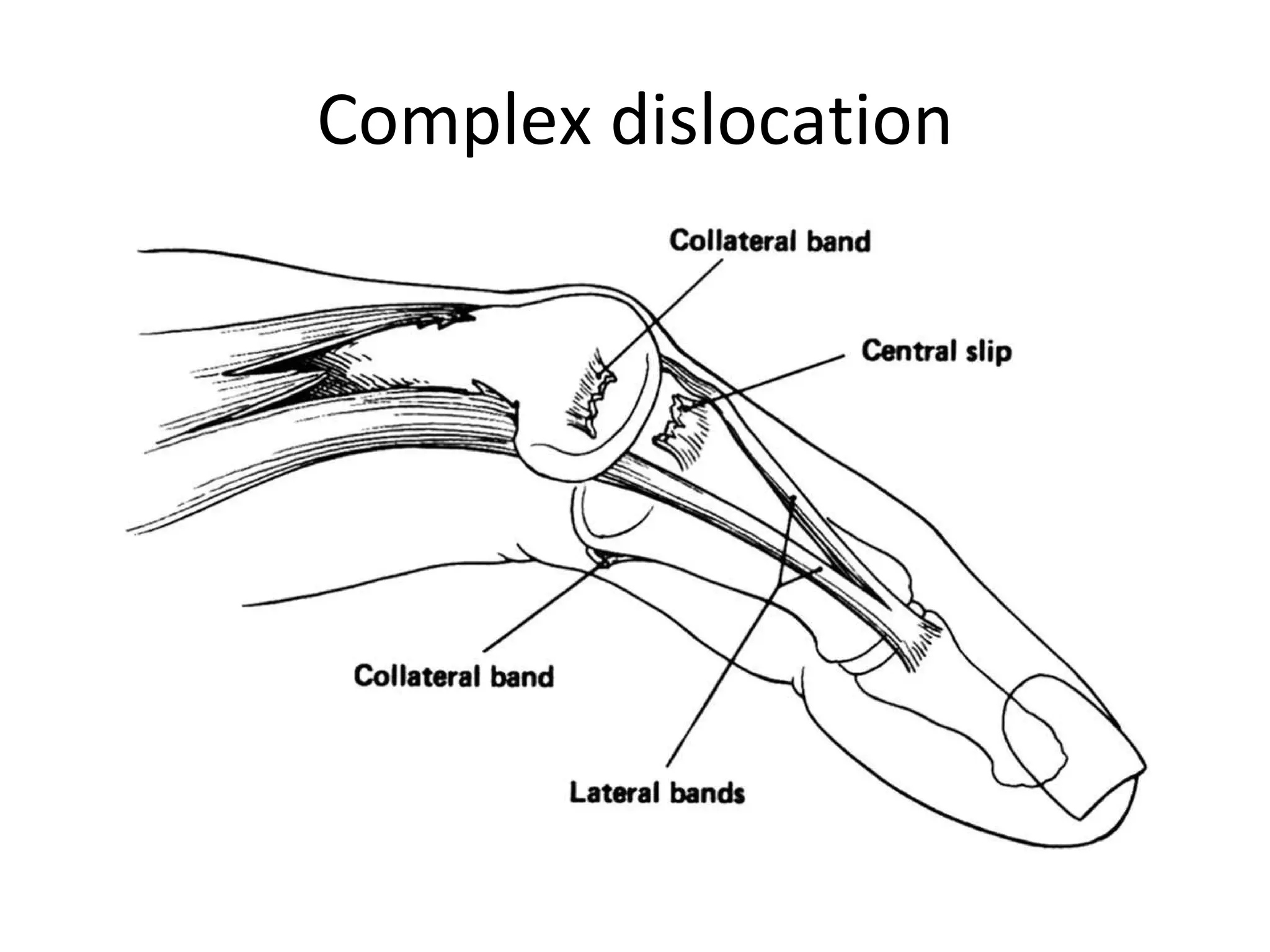 ortho 03 principle of closed reduction in fracture and dislocation | PPT