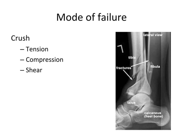 ortho 03 principle of closed reduction in fracture and dislocation | PPT