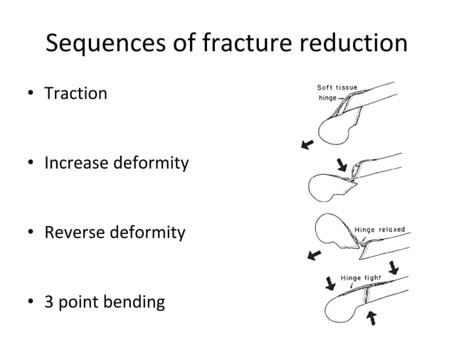 ortho 03 principle of closed reduction in fracture and dislocation | PPT