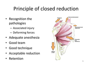ortho 03 principle of closed reduction in fracture and dislocation | PPT