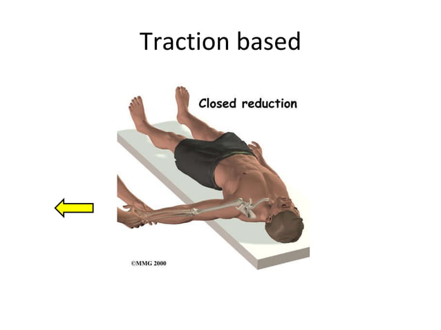 ortho 03 principle of closed reduction in fracture and dislocation | PPT