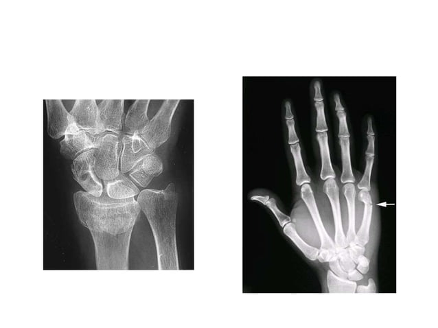 ortho 03 principle of closed reduction in fracture and dislocation | PPT