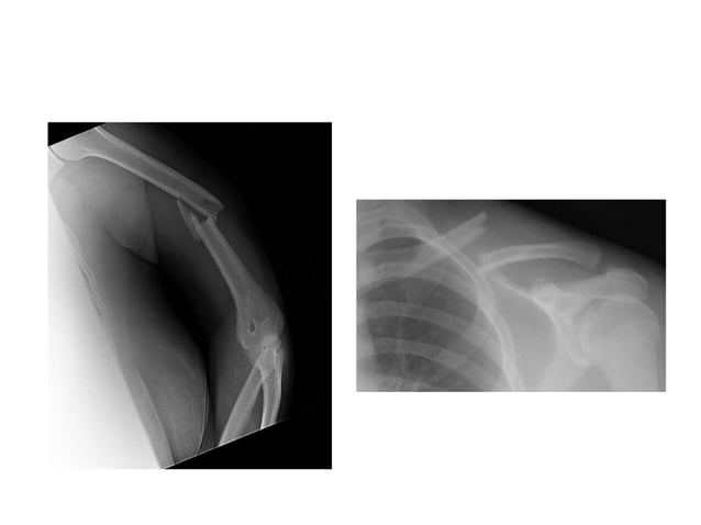 ortho 03 principle of closed reduction in fracture and dislocation | PPT