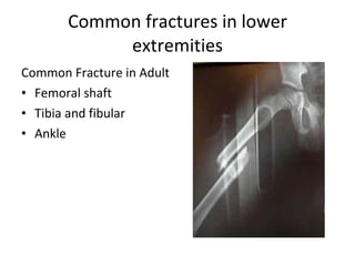 ortho 03 principle of closed reduction in fracture and dislocation | PPT