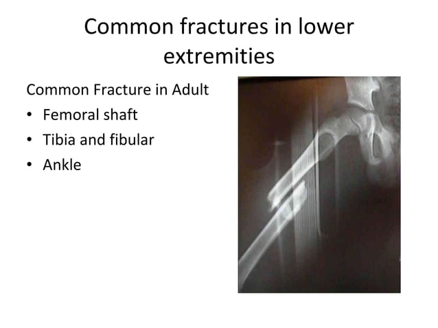 ortho 03 principle of closed reduction in fracture and dislocation | PPT