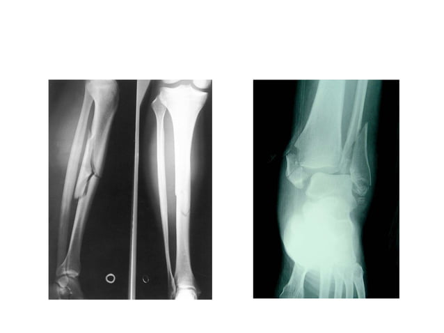 ortho 03 principle of closed reduction in fracture and dislocation | PPT