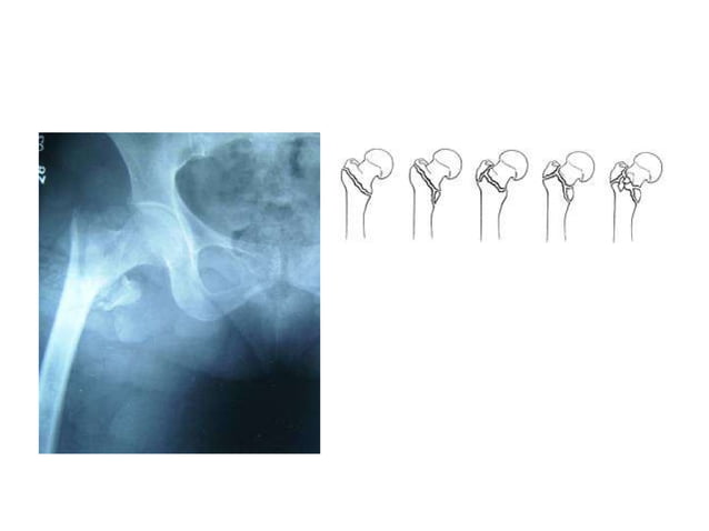 ortho 03 principle of closed reduction in fracture and dislocation | PPT