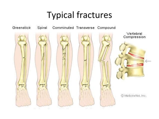 ortho 03 principle of closed reduction in fracture and dislocation | PPT
