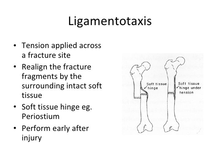 ortho 03 principle of closed reduction in fracture and dislocation