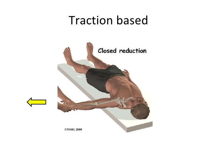 ortho 03 principle of closed reduction in fracture and dislocation