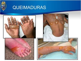 primeiros socorros em caso de queimaduras | PPT