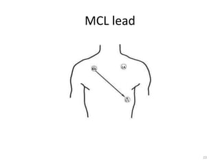 st elevation myocardial infarction (stemi) | PPTX