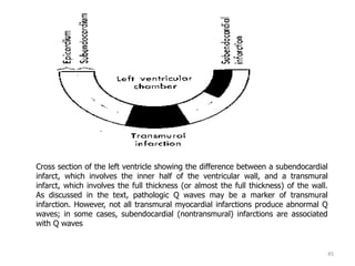 st elevation myocardial infarction (stemi) | PPTX