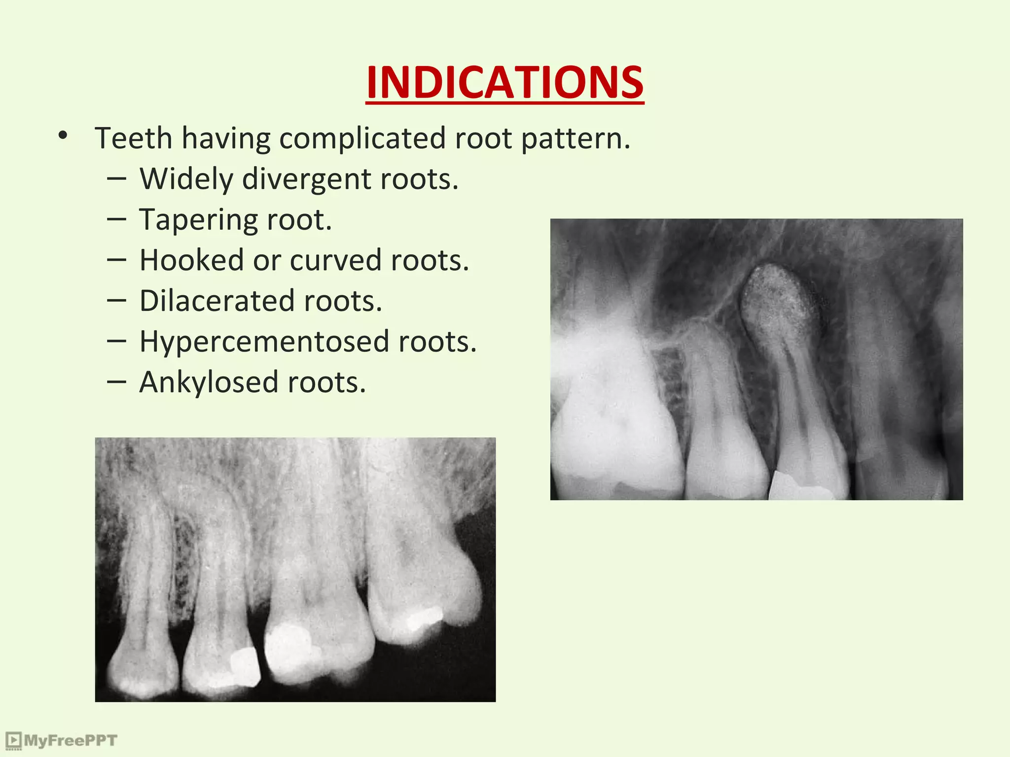 Surgical removal of teeth and roots | PPT