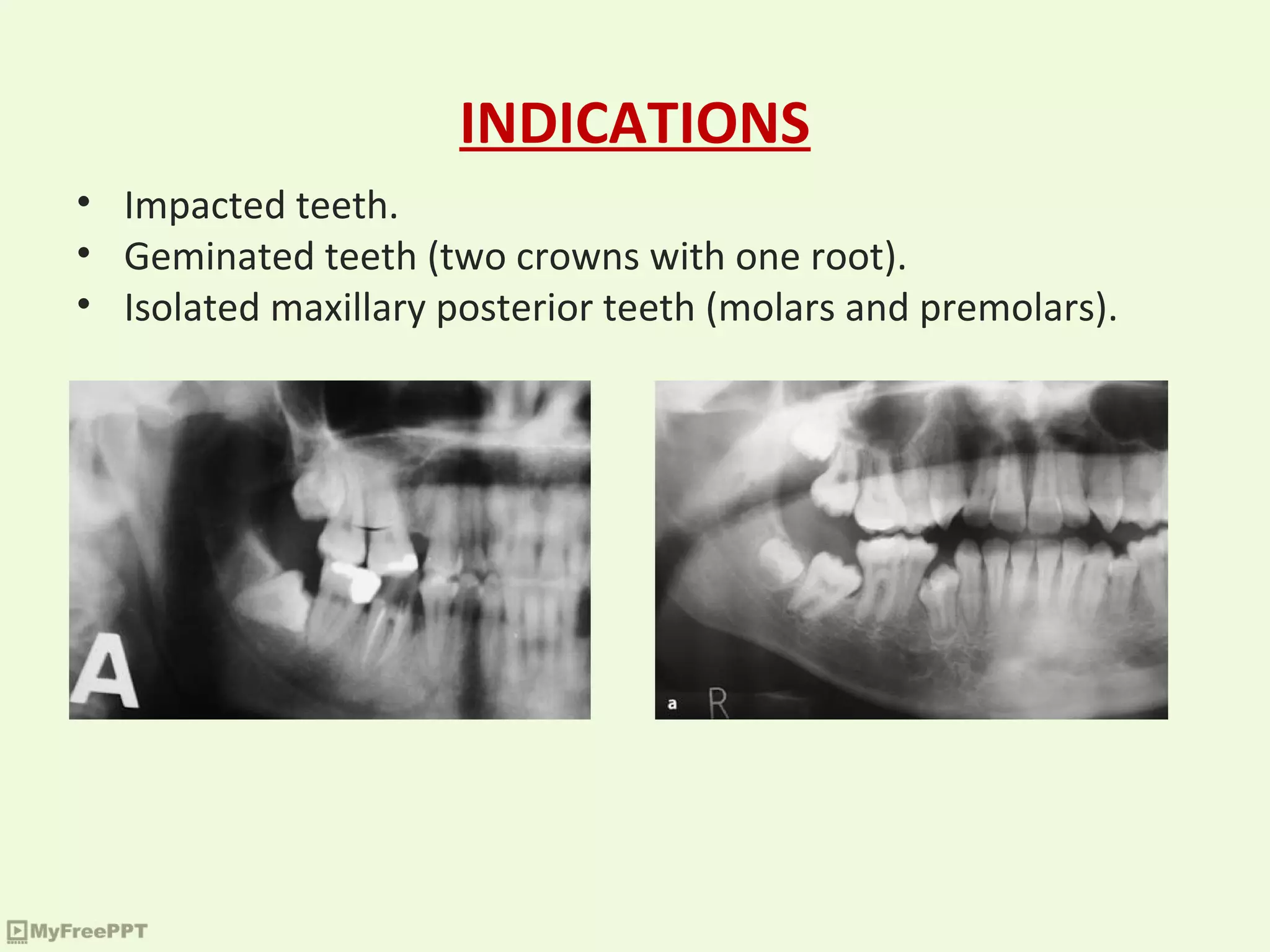 Surgical removal of teeth and roots | PPT
