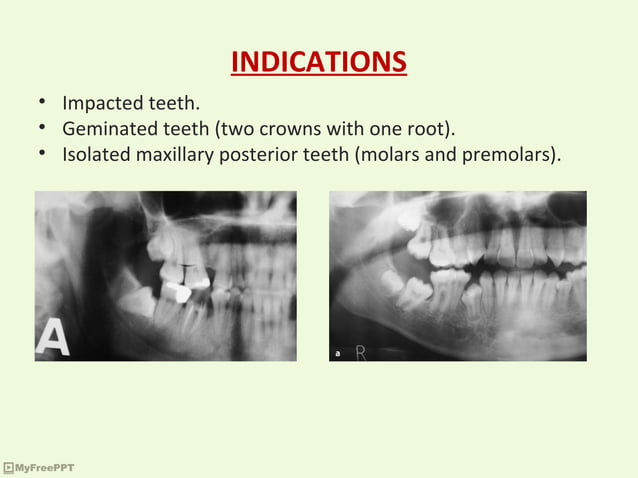 Surgical removal of teeth and roots | PPT | Dental Health | Diseases ...