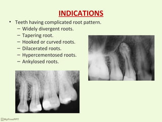 Surgical removal of teeth and roots