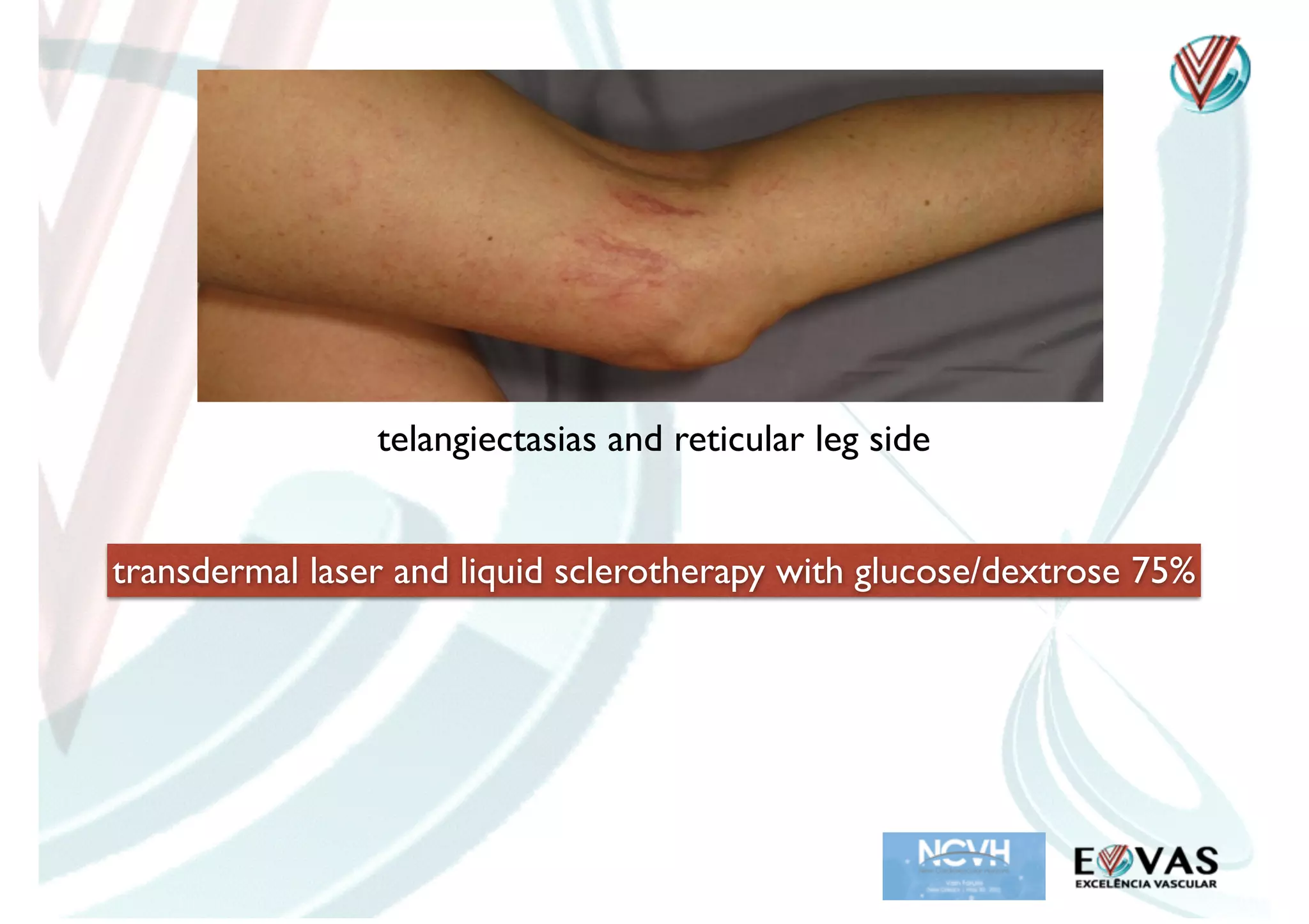 The brazilian experience in superficial venous insufficiency and what ...