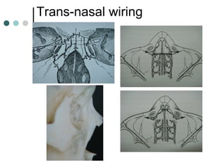 Traumatic Telecanthus