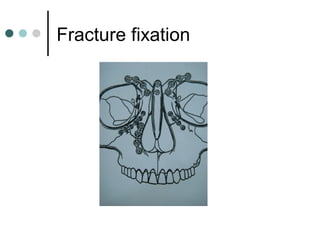 Traumatic Telecanthus