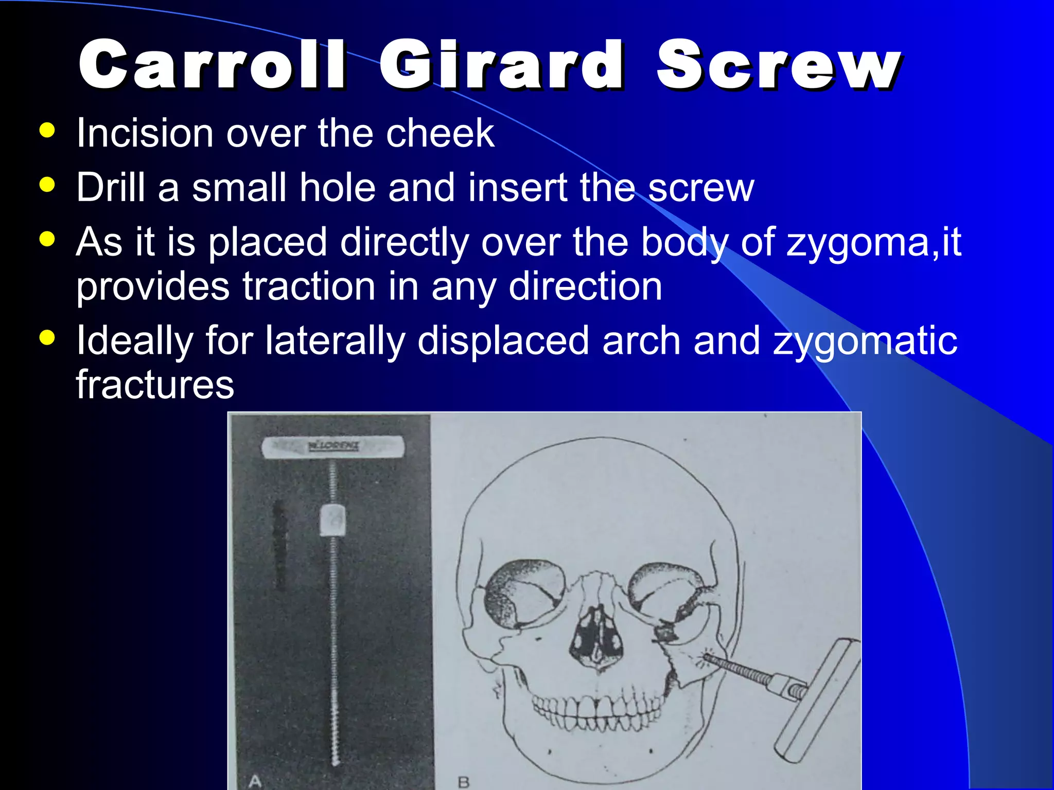 zygomatic reduction,which comes when | PPT