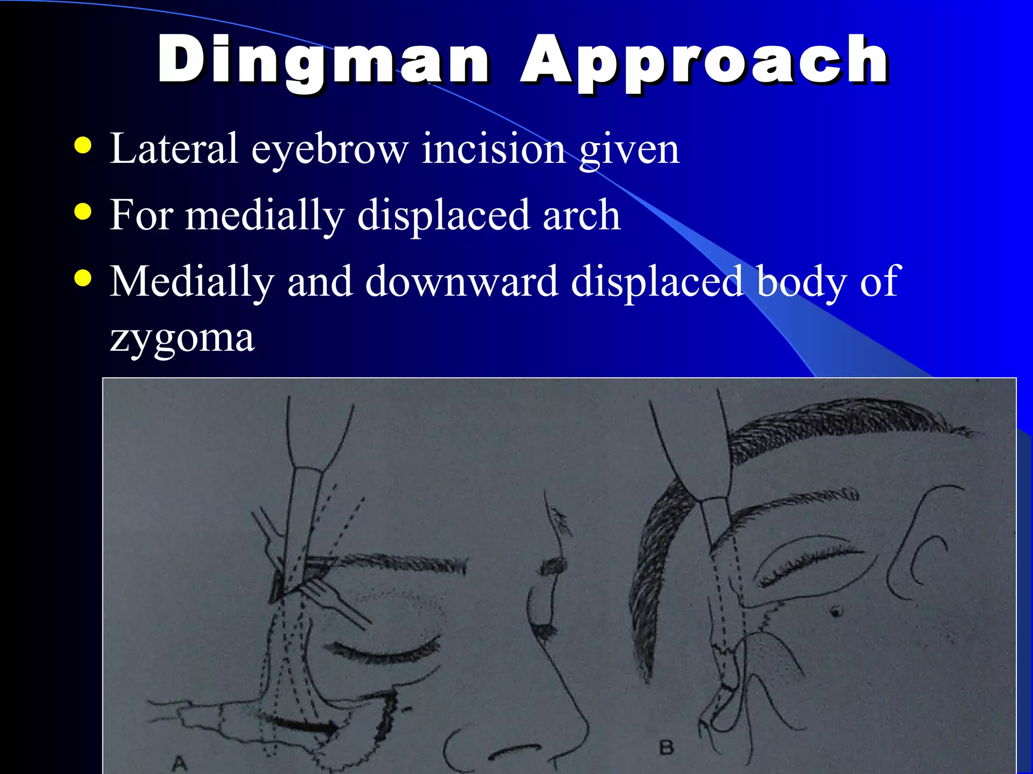 zygomatic reduction,which comes when | PPT