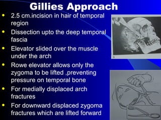 zygomatic reduction,which comes when | PPT