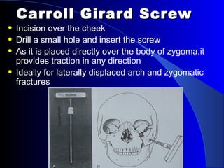 zygomatic reduction,which comes when | PPT