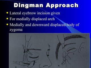 zygomatic reduction,which comes when | PPT