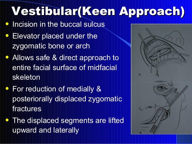 zygomatic reduction,which comes when