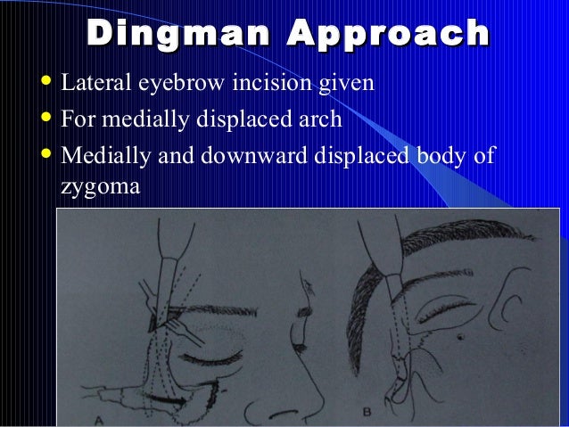 zygomatic reduction,which comes when