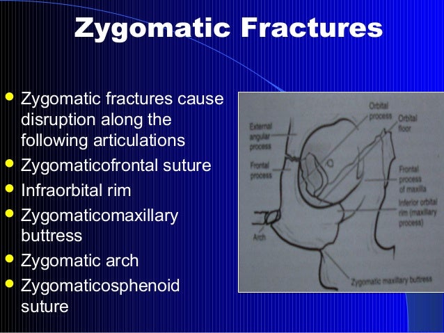 zygomatic reduction,which comes when