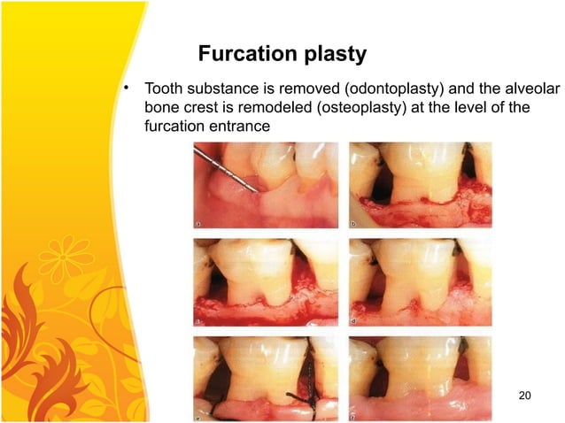 030.furcation involvement and its therapy | PPT
