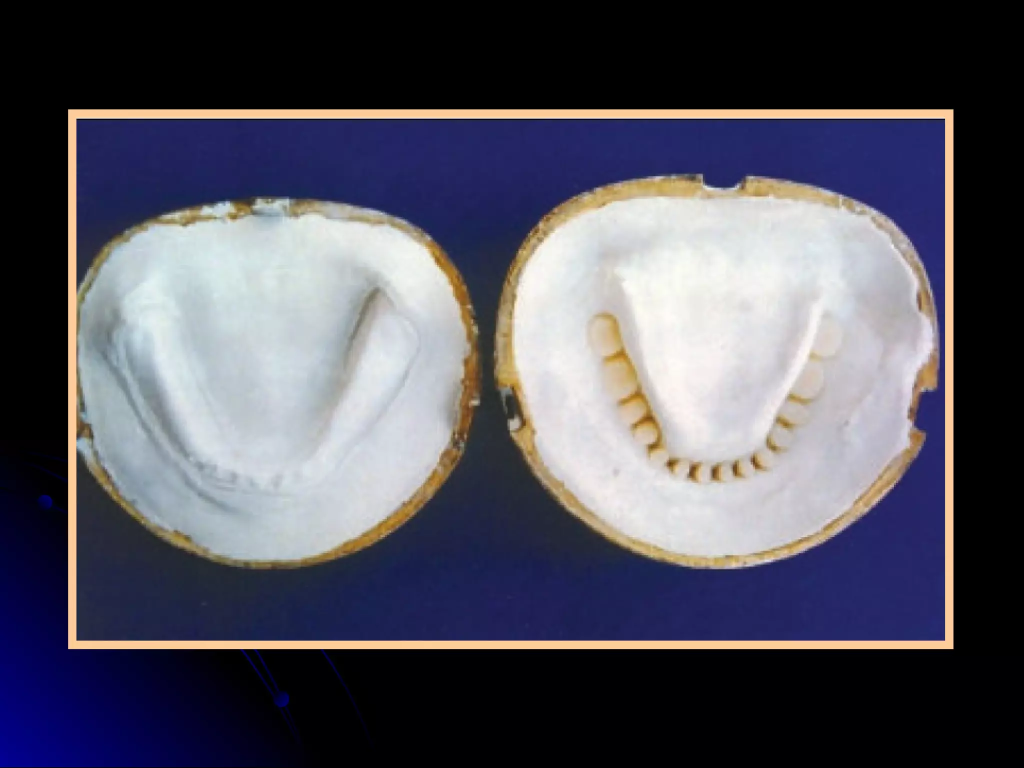 03 01 01_45-(flasking and processing complete denture) | PPT