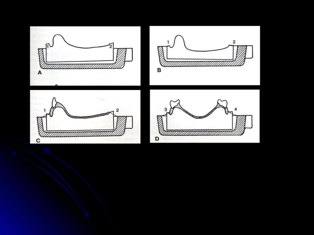 03 01 01_45-(flasking and processing complete denture) | PPT | Dental ...